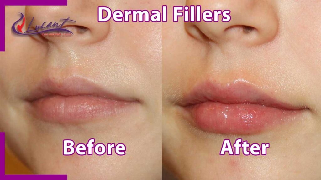 Dermal Fillers in Kathmandu Nepal | Facial Rejuvenation