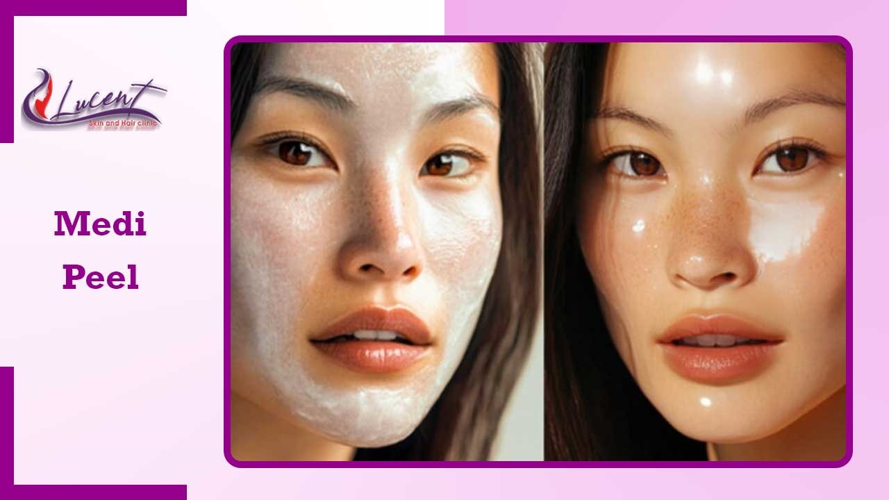 Medi Peel/Glow Peel in Nepal |Chemical Peel for Glowing Skin