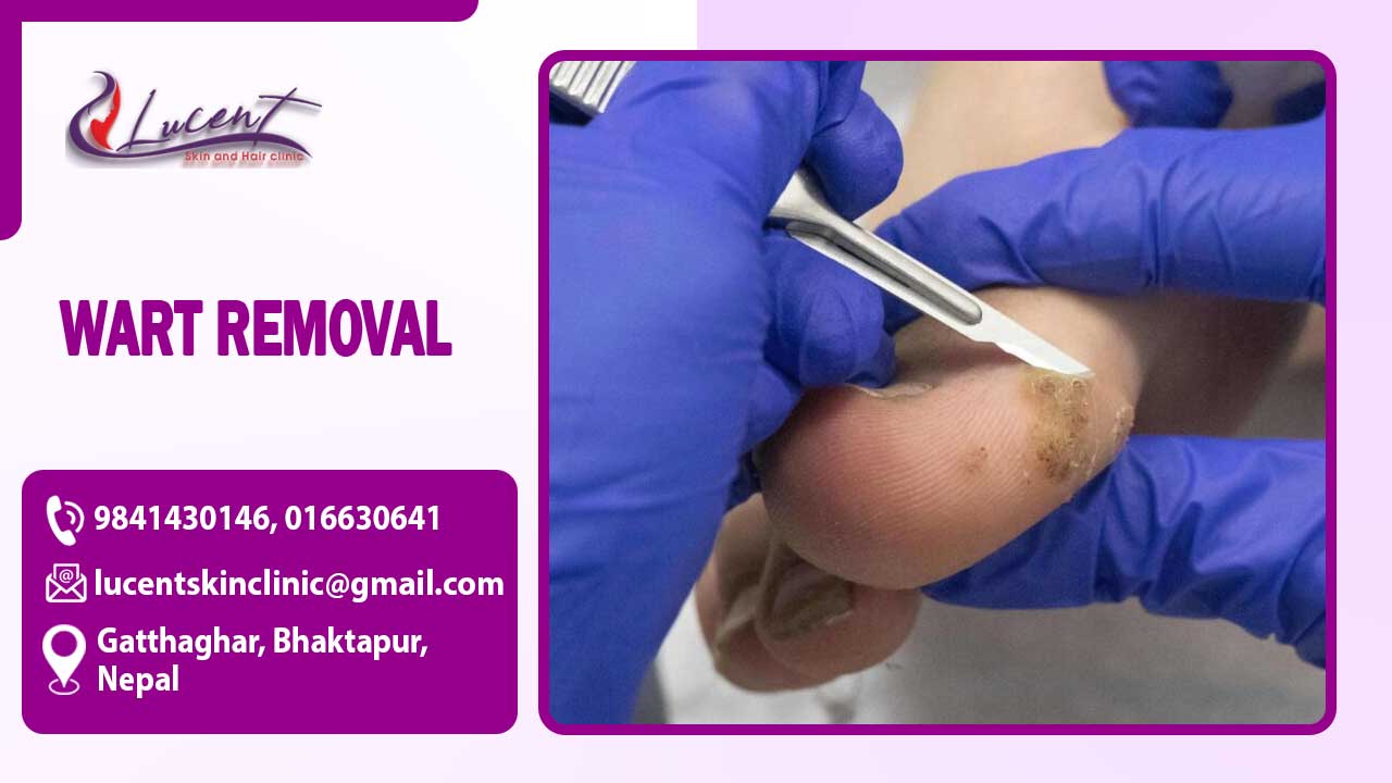 Dealing with a single wart/multiple? Wart removal in Nepal