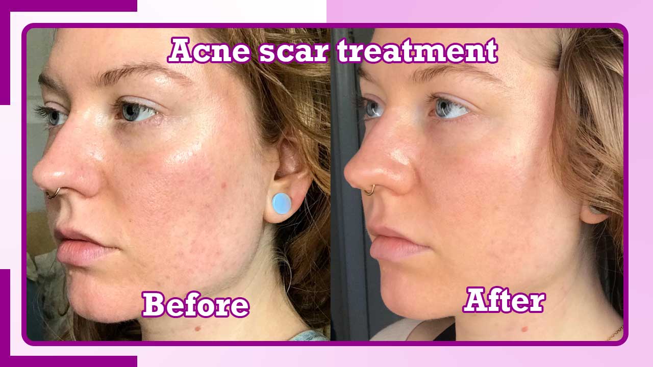 Book Your Acne Scar Treatment at Lucent Skin and Hair Clinic