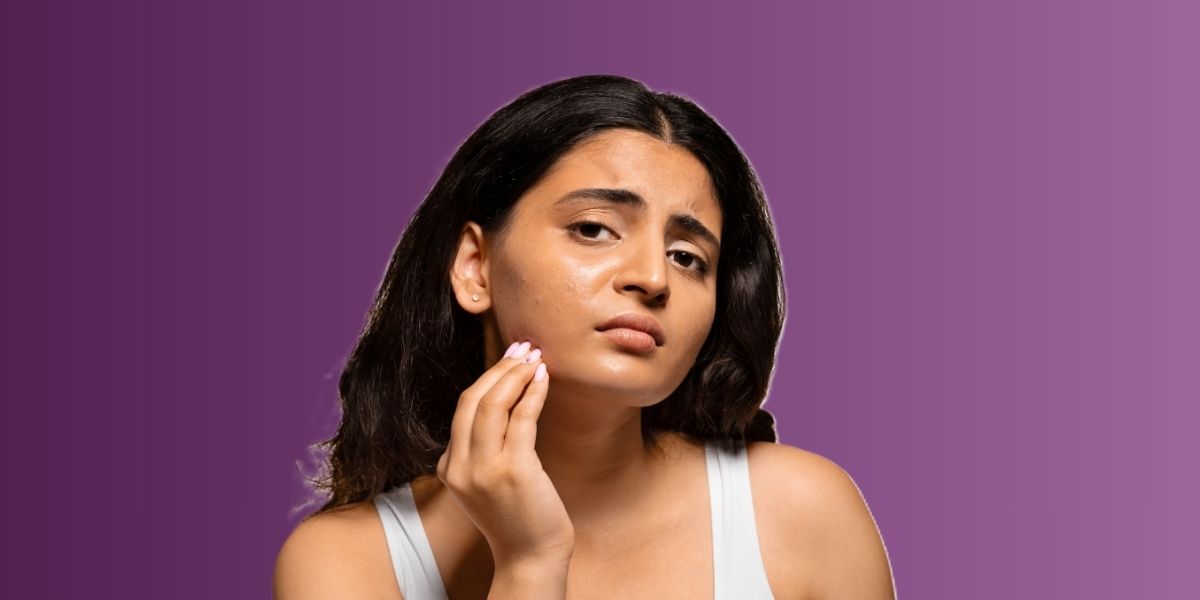 Hyperpigmentation Treatment: Symptoms, Causes, Diagnosis & Care